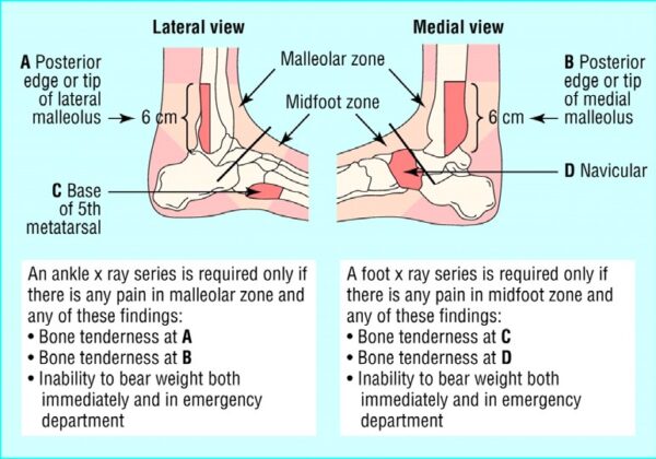 What you should do and shouldn’t do for your ankle sprain